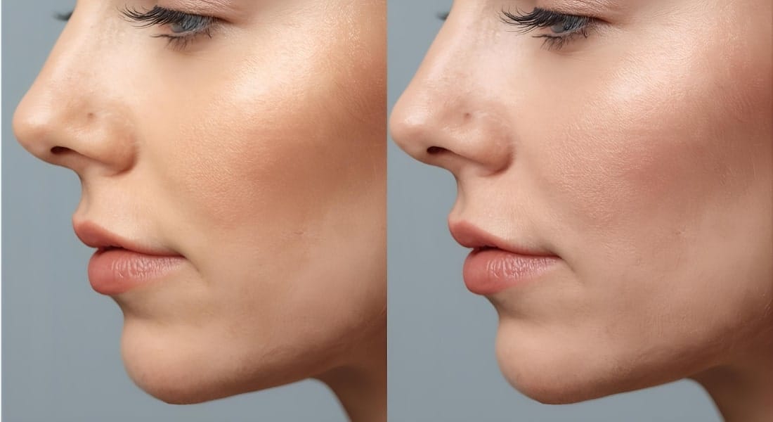 PDO Threads vs. Dermal Fillers: A Comparative Guide (B2B)